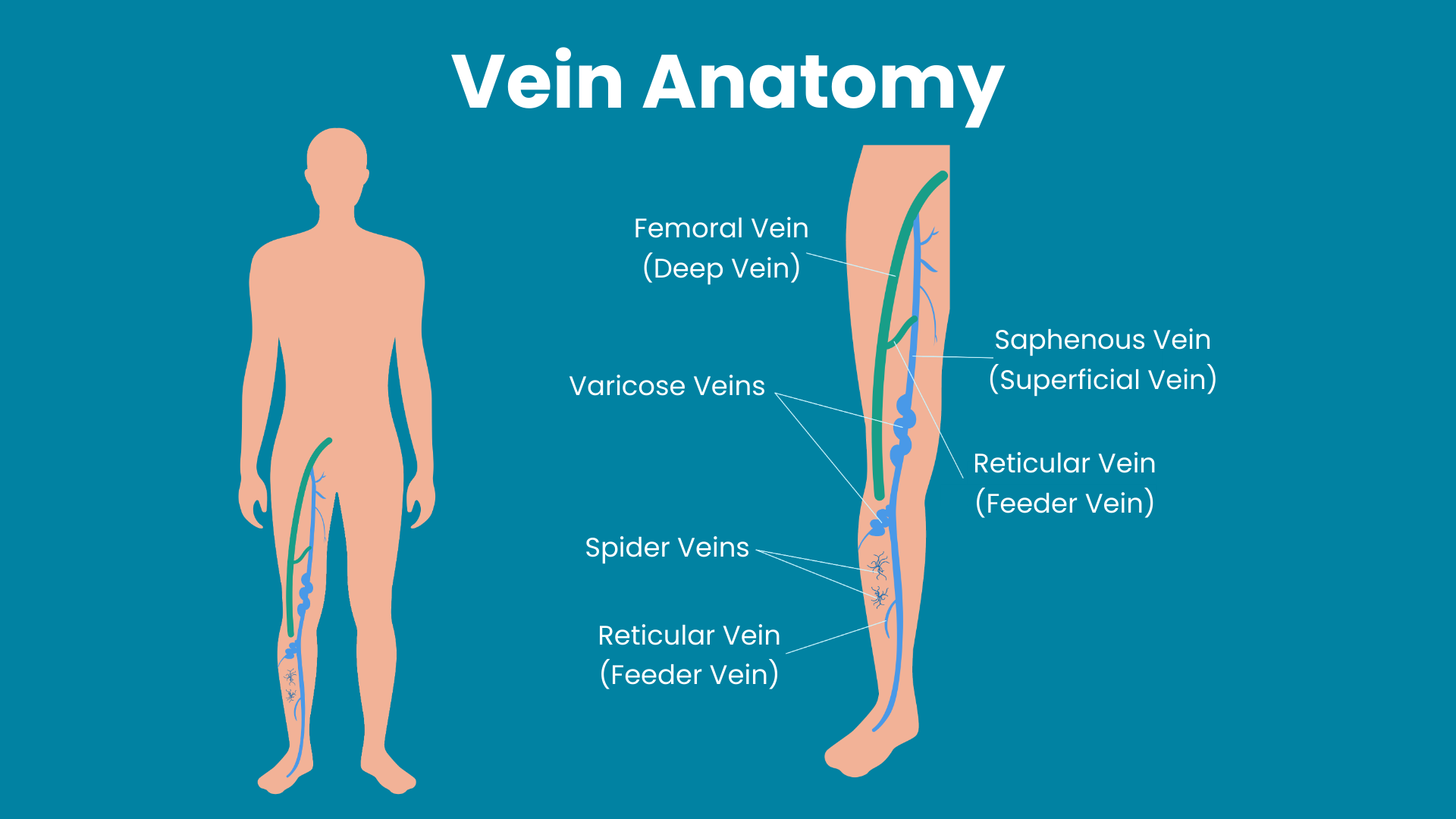 All About Varicose Veins - Elite Vein Clinic