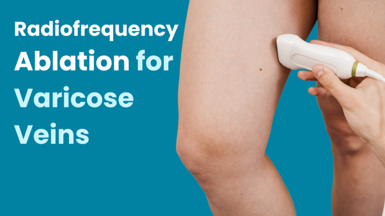 Radiofrequency Ablation for Varicose Veins - Elite Vein Clinic