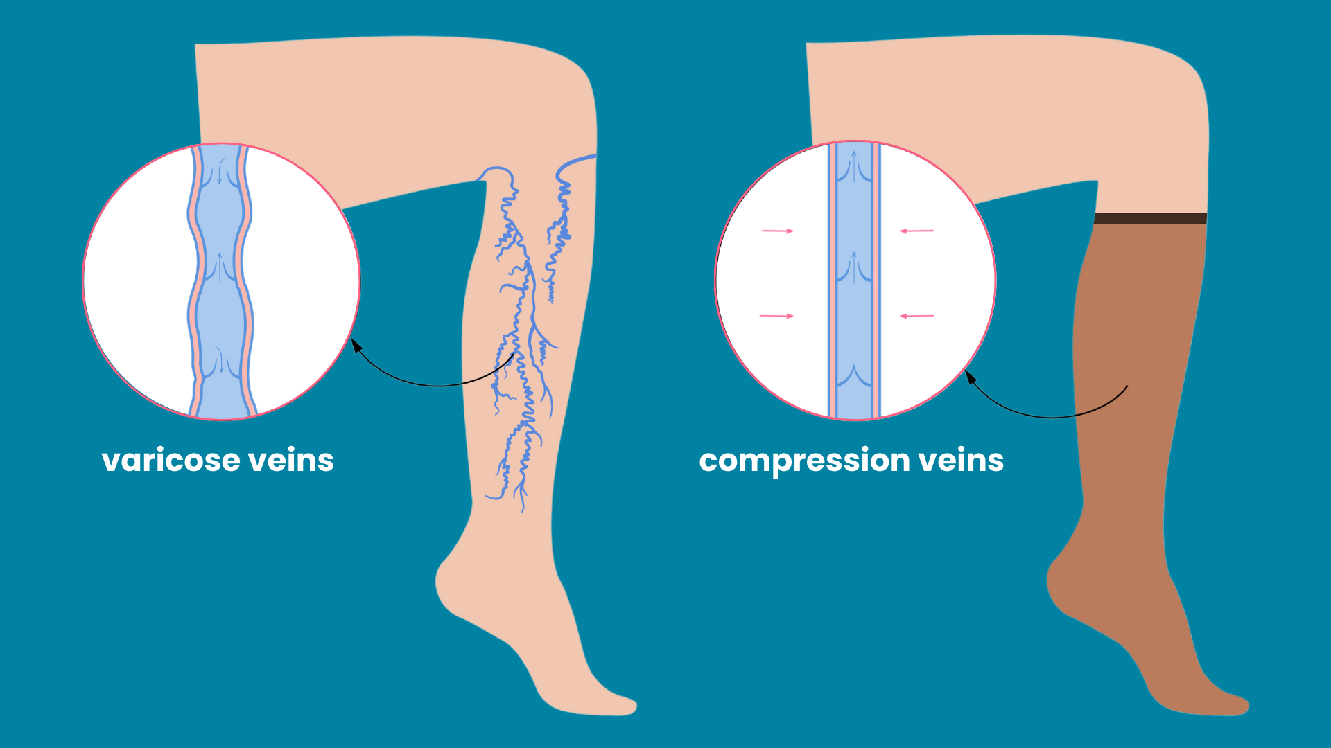 Best Compression Stockings for Varicose Veins - Elite Vein Clinic